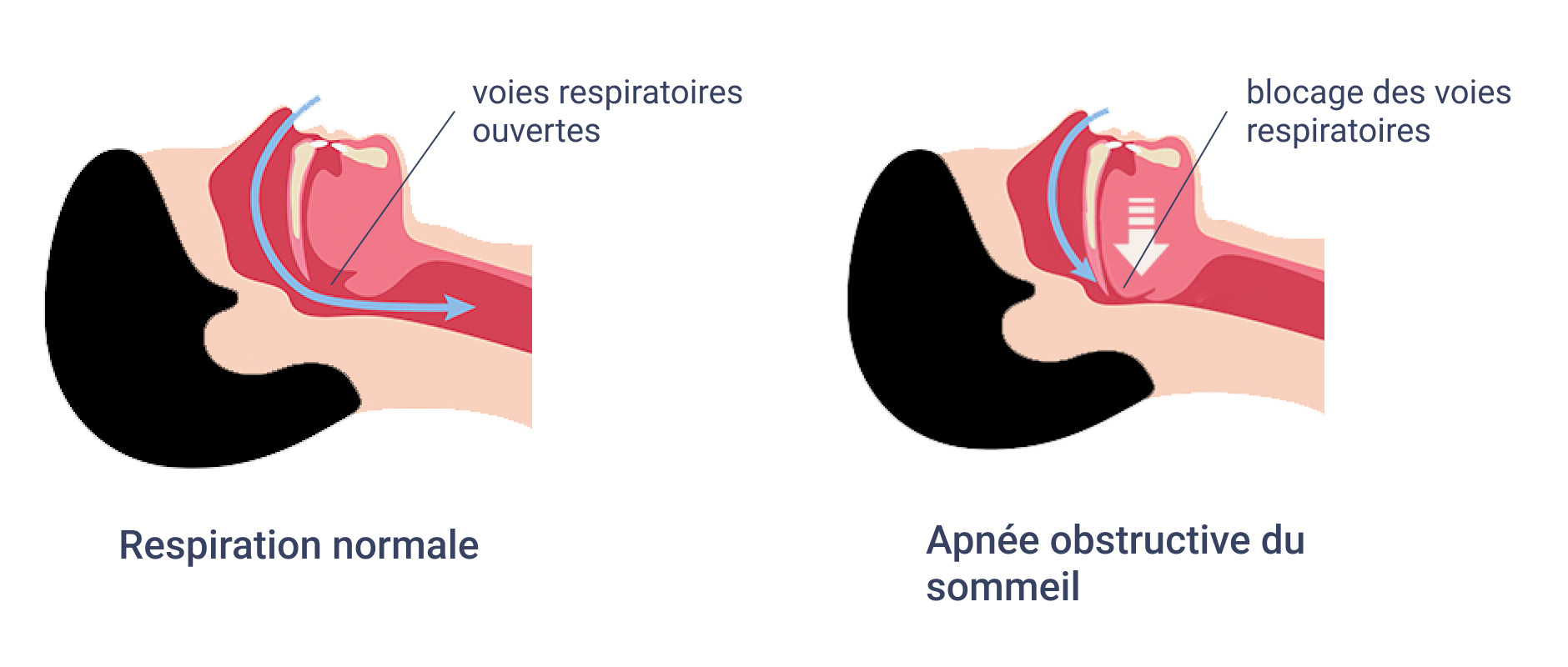 Comprendre l’apnée obstructive du sommeil