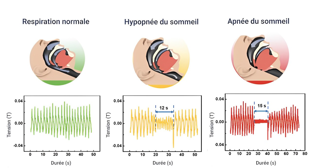 Indice d'apnée-hypopnée (IAH)