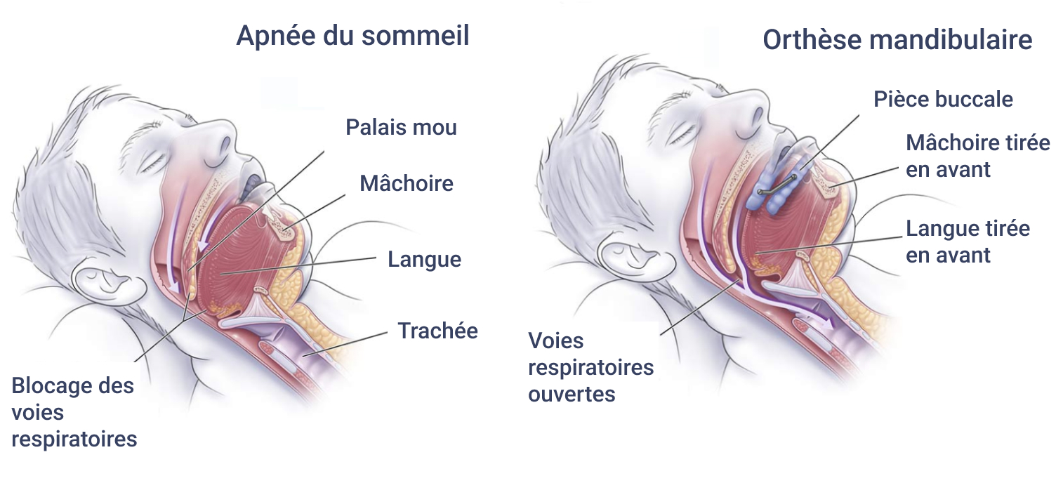 Le traitement par orthèse mandibulaire pour apnée du sommeil