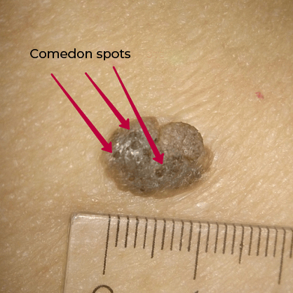 Keratoma: symptoms, treatment, prevention