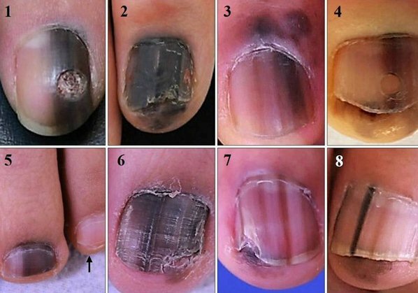 Nail melanoma: symptoms, photos, stages