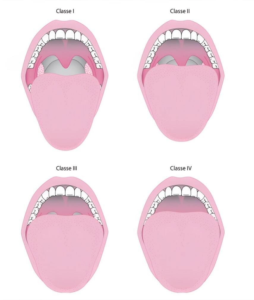 Quel lien entre l’apnée du sommeil et le score de Mallampati