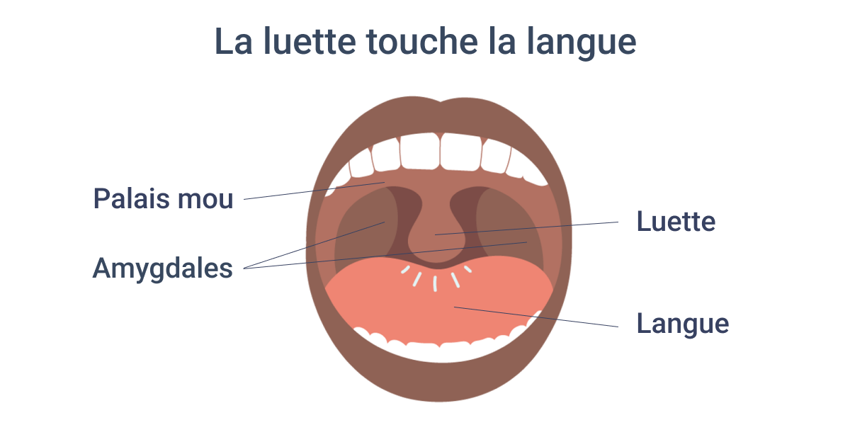La luette touche la langue : Un signe d'apnée du sommeil