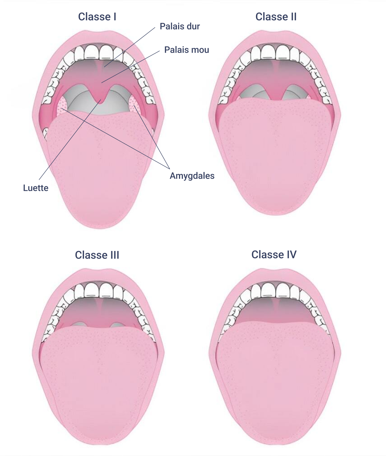 Quel lien entre l’apnée du sommeil et le score de Mallampati