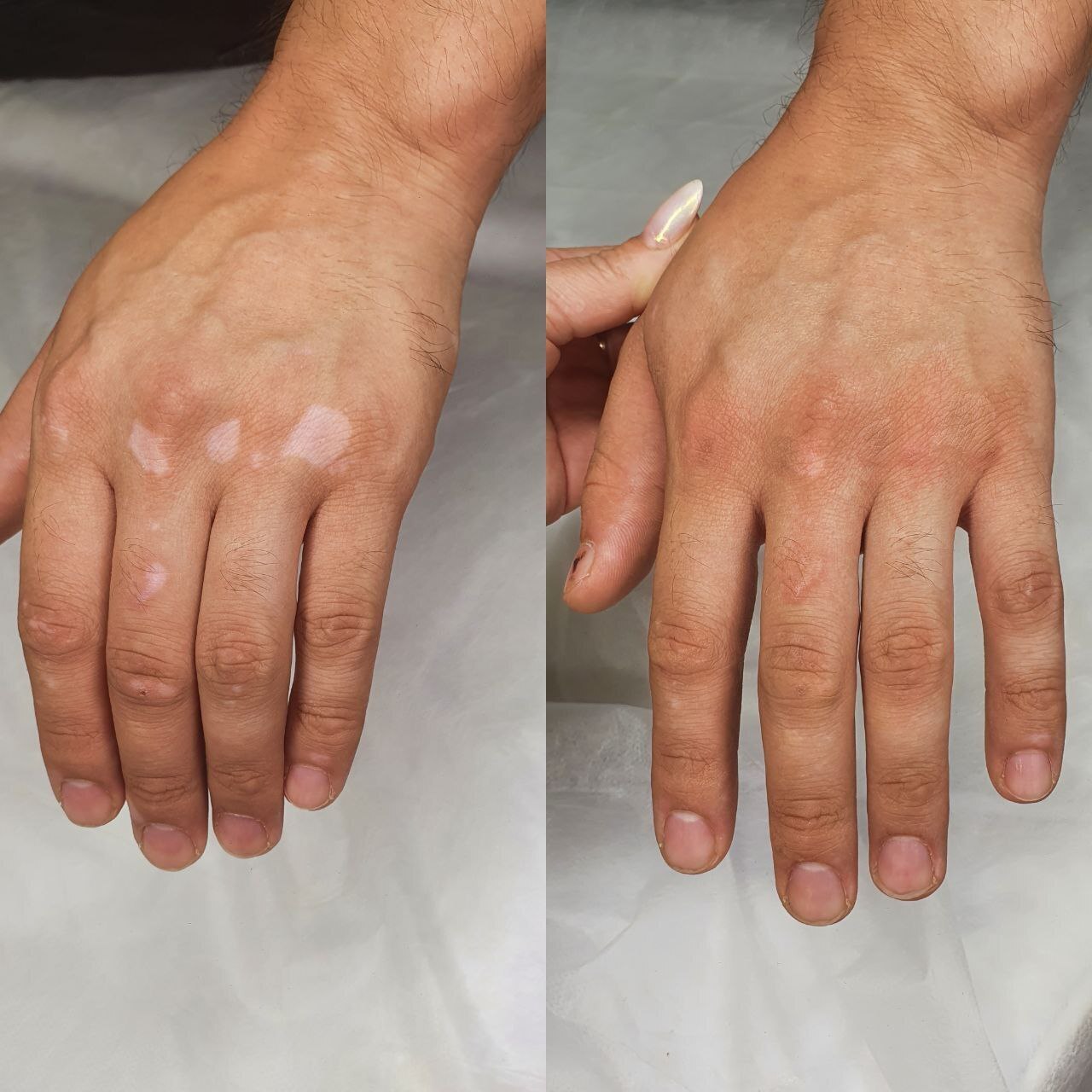 EXPERTE DERMOGRAPHE Paris | Camouflage cicatrices sans chirurgie