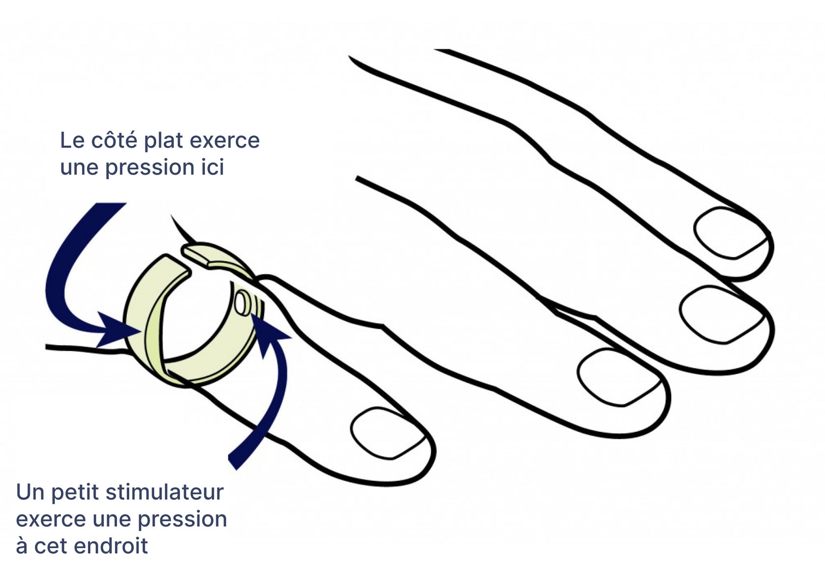 Bagues anti ronflement : avis, fonctionnement