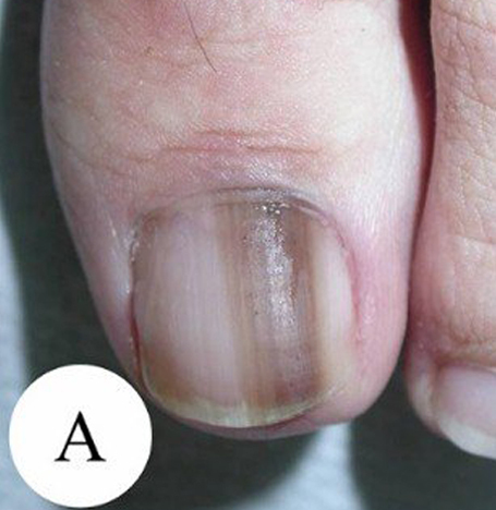 Nail melanoma: symptoms, photos, stages