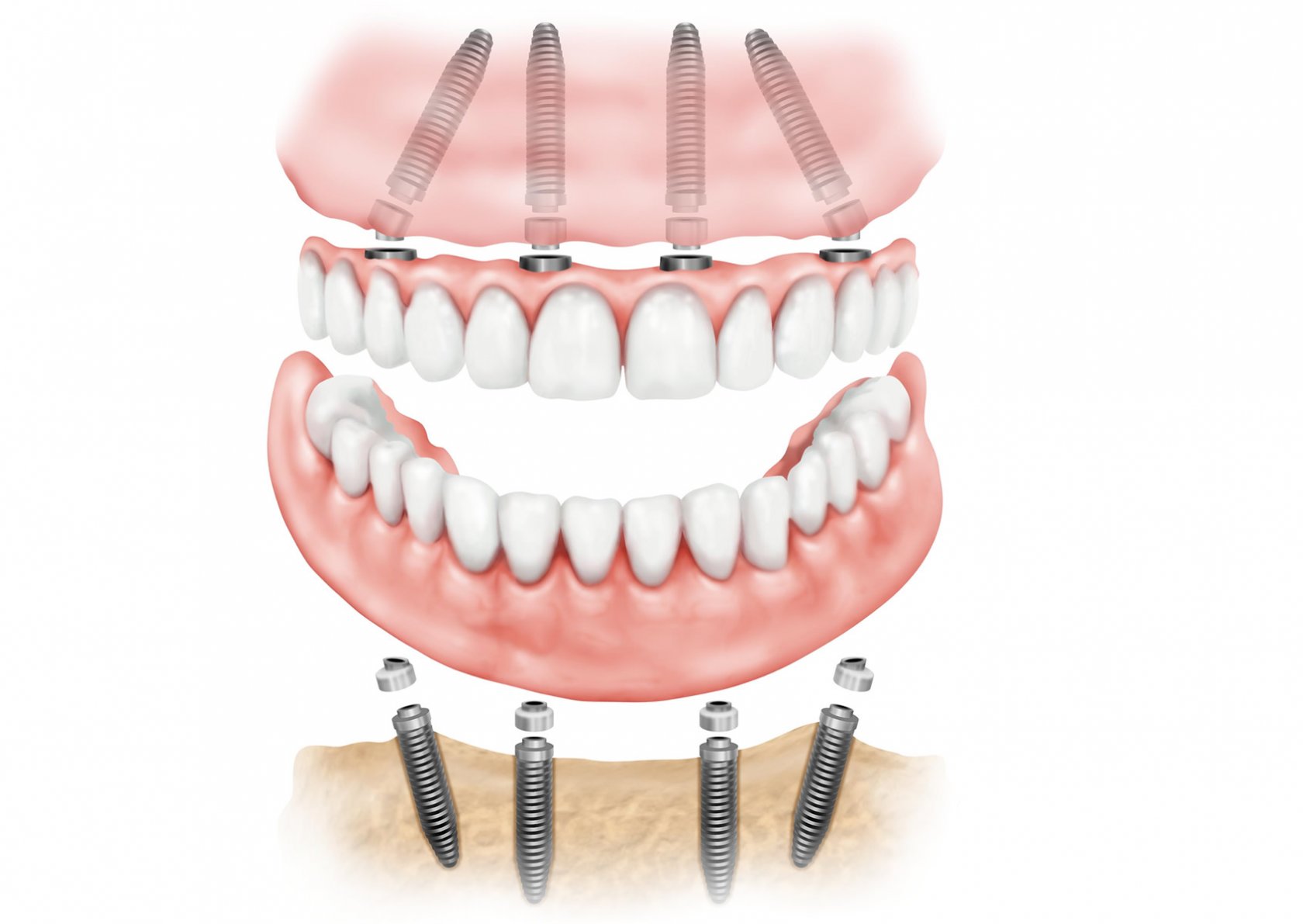 Fusion Dental Implants – Advanced Tooth Replacement in Roseville, CA