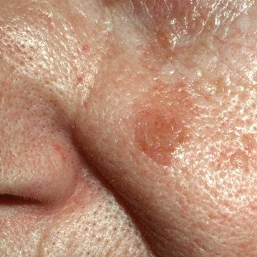 Keratoma: symptoms, treatment, prevention